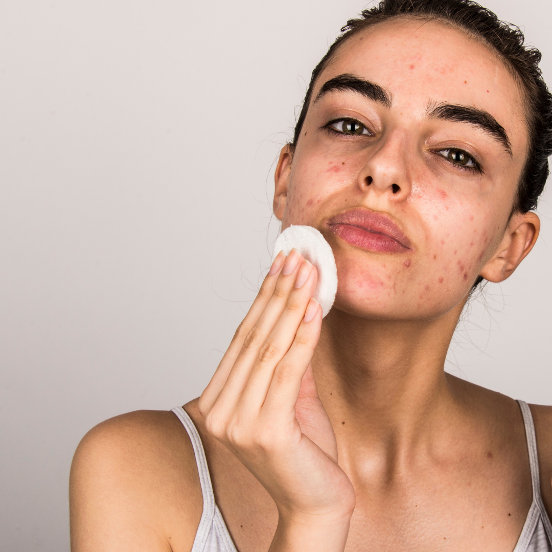 Acne & Breakouts | Causes & Treatments - Believe in Beautiful