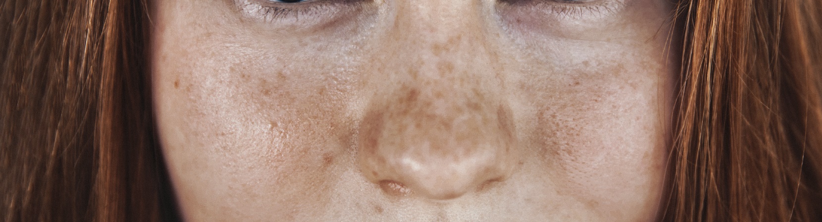 Depigmentation: Causes & 7 Great Treatment Options - Believe in Beautiful
